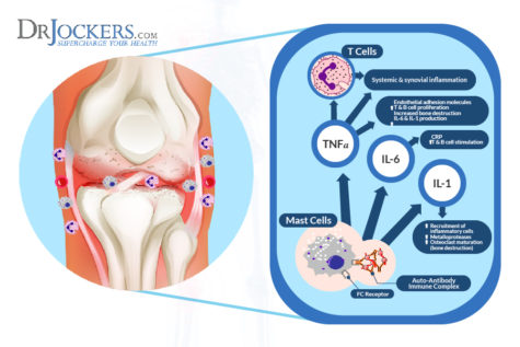 Rheumatoid Arthritis: Symptoms, Causes and Support Strategies
