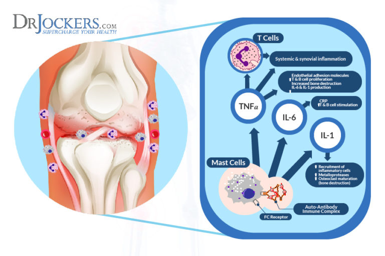Rheumatoid Arthritis: Symptoms, Causes and Support Strategies