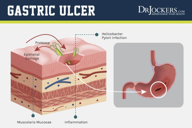 The Damaging Effects of H Pylori Infections - DrJockers.com