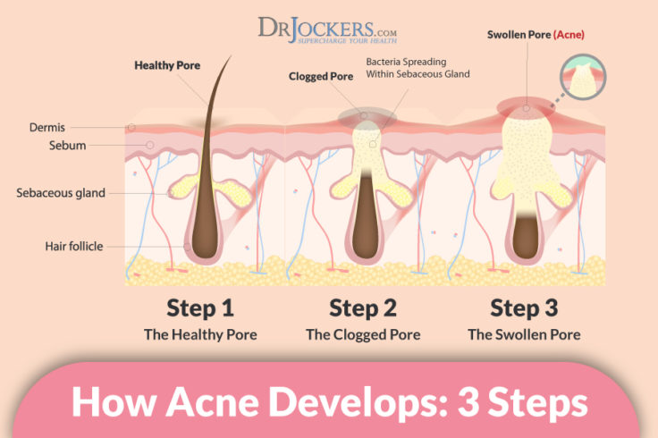 Is The Gut-Brain Skin Axis to Blame For Anxiety and Acne