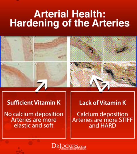 3 Major Benefits of Vitamin K2 For Your Heart and Bones