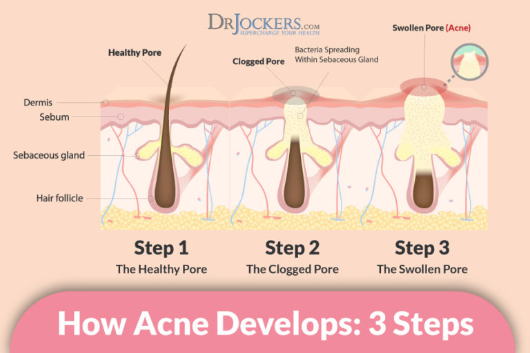 10 Things Acne Means About Your Health - DrJockers.com