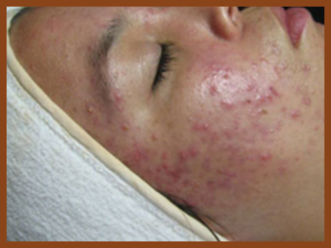 10 Things Acne Means About Your Health - DrJockers.com