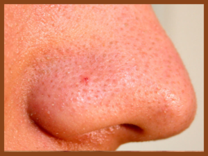 10 Things Acne Means About Your Health - DrJockers.com