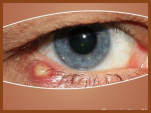 10 Things Acne Means About Your Health - DrJockers.com