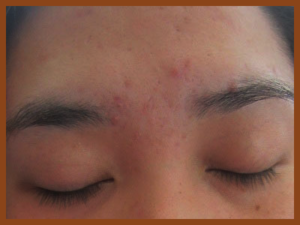 10 Things Acne Means About Your Health - DrJockers.com