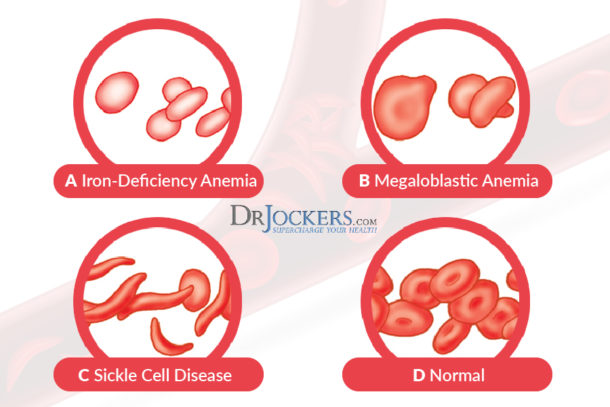 Anemia: Causes, Symptoms and Support Strategies - DrJockers.com