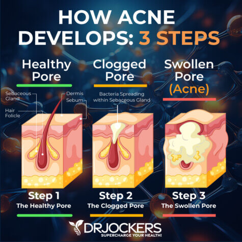 10 Things Acne Means About Your Health - DrJockers.com