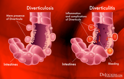 Diverticulitis: Causes, Symptoms & Natural Support Strategies