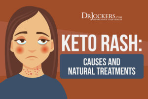 Keto Rash: Causes and Natural Treatments - DrJockers.com