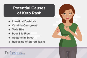 Keto Rash: Causes and Natural Treatments - DrJockers.com
