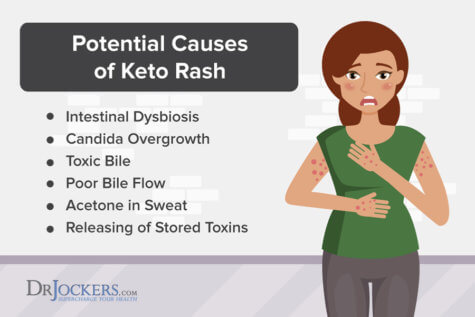 Keto Rash: Causes and Natural Treatments - DrJockers.com