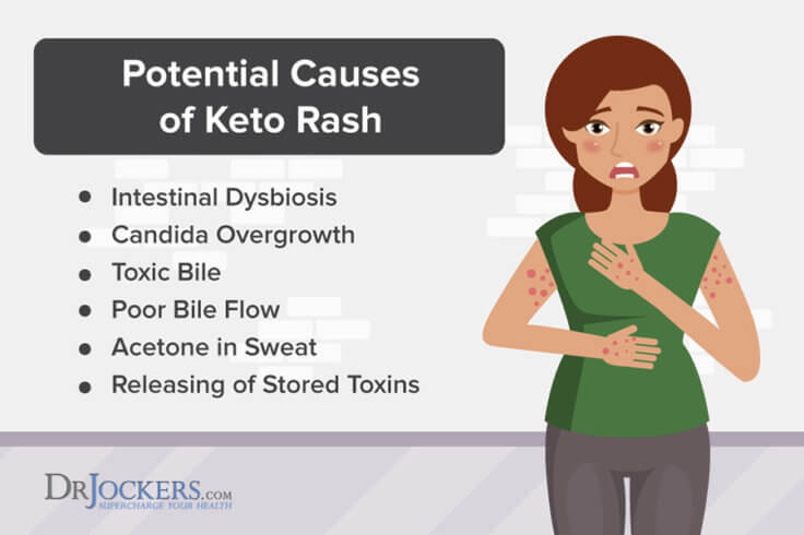 Keto Rash: Causes and Natural Treatments - DrJockers.com