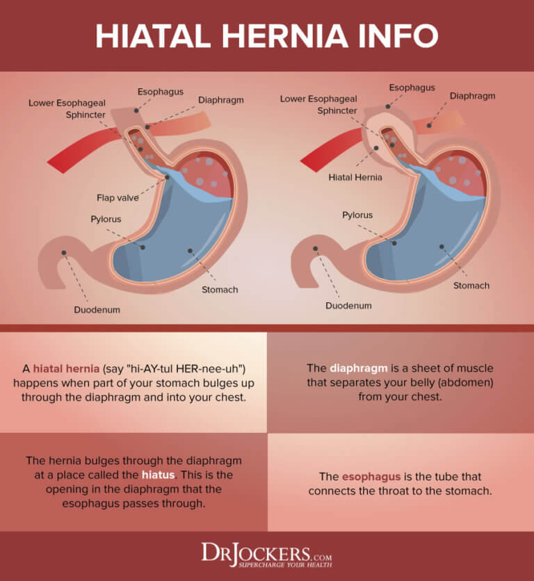Hiatal Hernia: Symptoms, Causes and Natural Support Strategies