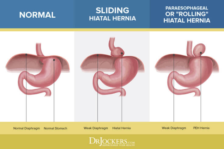Hiatal Hernia: Symptoms, Causes and Natural Support Strategies