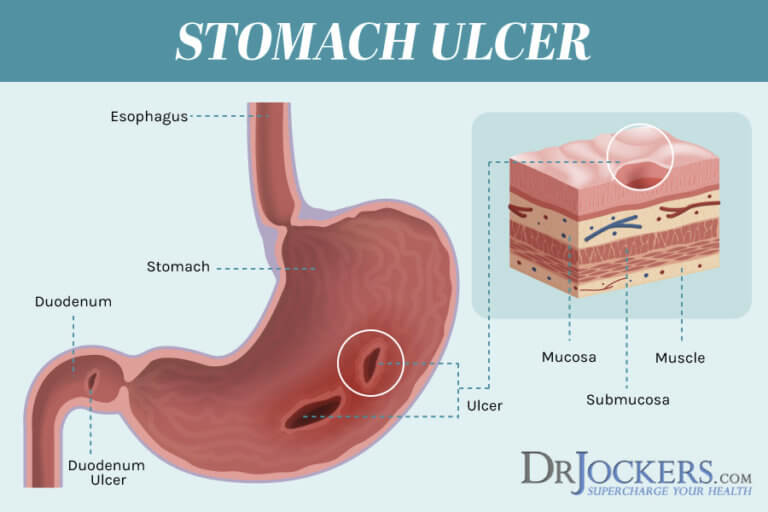 Stomach Ulcers: Causes and Natural Support Strategies - DrJockers.com