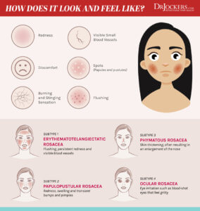 Rosacea: Causes and Natural Support Strategies - DrJockers.com