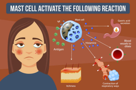 Mast Cell Activation Syndrome: Symptoms and Support Strategies