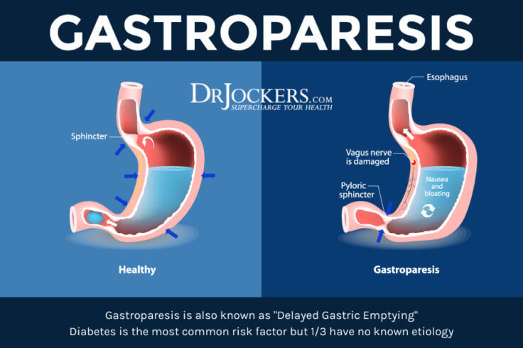 Gastroparesis: Symptoms, Causes and Natural Support Strategies