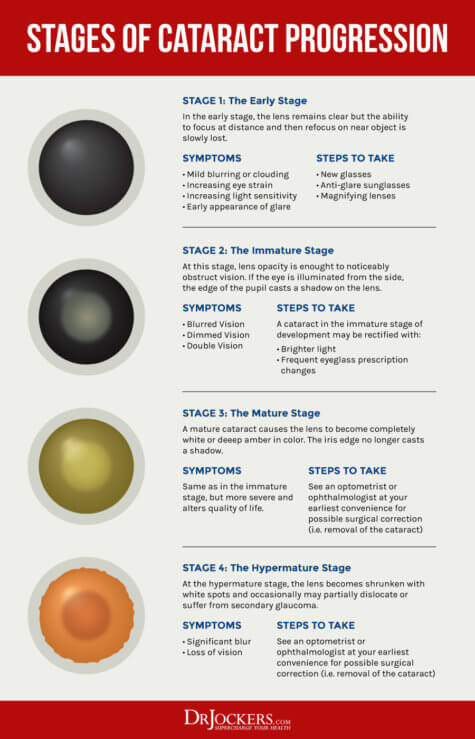 Cataracts: Causes, Symptoms & Natural Support Strategies