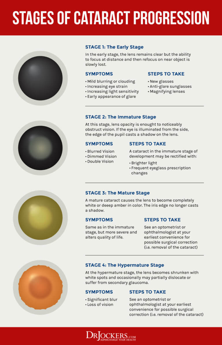 Cataracts: Causes, Symptoms & Natural Support Strategies
