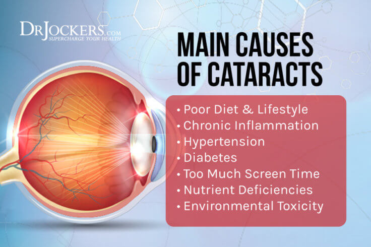 Cataracts: Causes, Symptoms & Natural Support Strategies