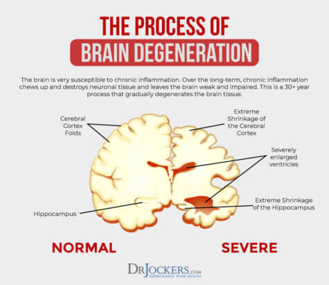 Brain Degeneration: Causes, Symptoms & Solutions - DrJockers.com