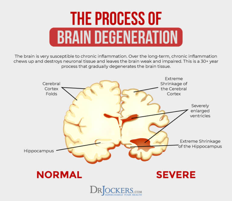 Brain Degeneration: Causes, Symptoms & Solutions - DrJockers.com