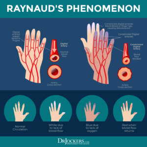 Raynaud's Phenomenon: Causes, Symptoms & Support Strategies