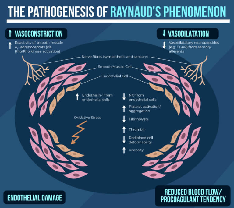 Raynaud's Phenomenon: Causes, Symptoms & Support Strategies