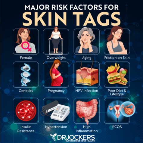 Skin Tags: Major Causes and Natural Support Strategies - DrJockers.com