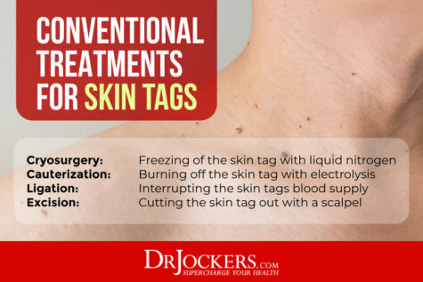 Skin Tags: Major Causes and Natural Support Strategies - DrJockers.com