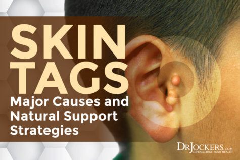 Skin Tags: Major Causes and Natural Support Strategies - DrJockers.com