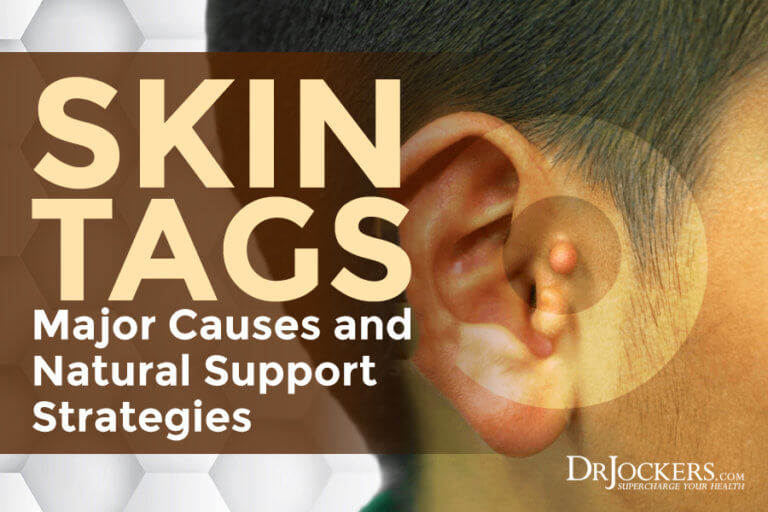 Skin Tags: Major Causes and Natural Support Strategies - DrJockers.com