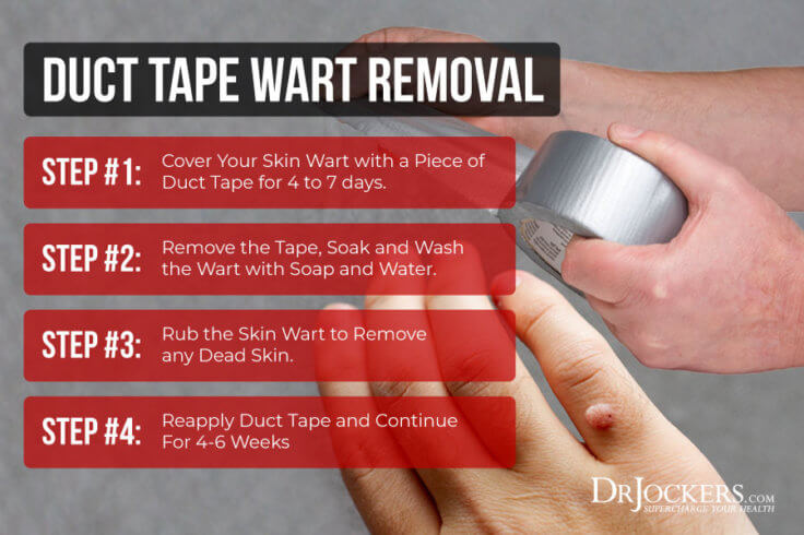 Skin Warts: Major Causes and Natural Support Strategies