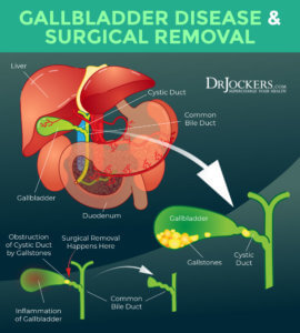 No Gallbladder: Strategies to Improve Digestive Health