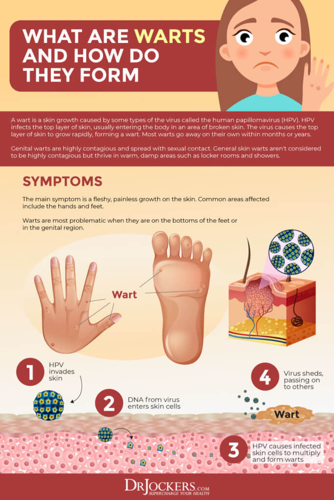 Skin Warts: Major Causes and Natural Support Strategies