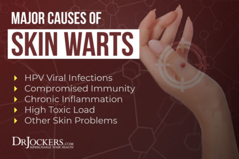 Skin Warts: Major Causes and Natural Support Strategies
