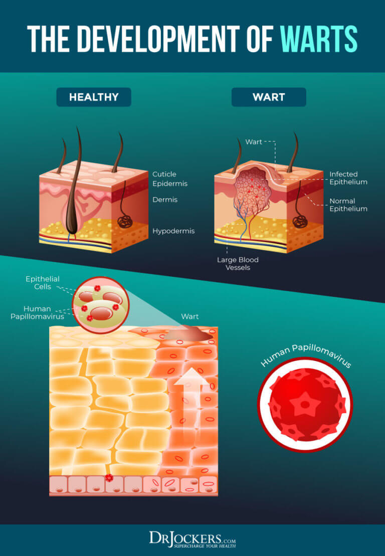 Skin Warts: Major Causes and Natural Support Strategies