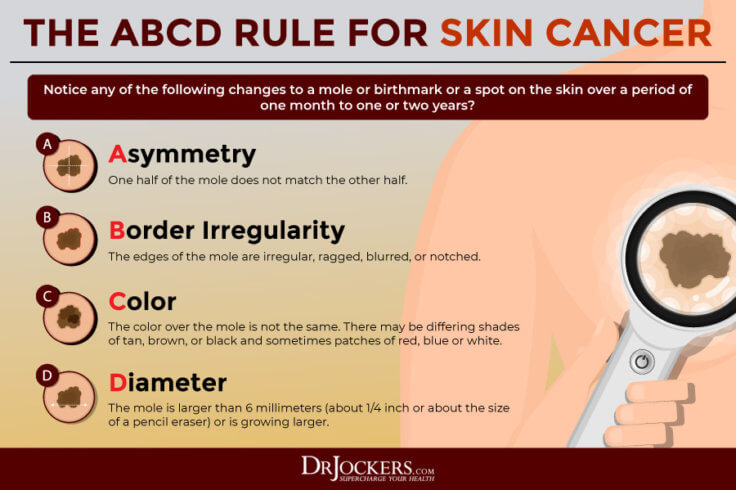 Skin Cancer: Symptoms, Causes and Natural Support Strategies