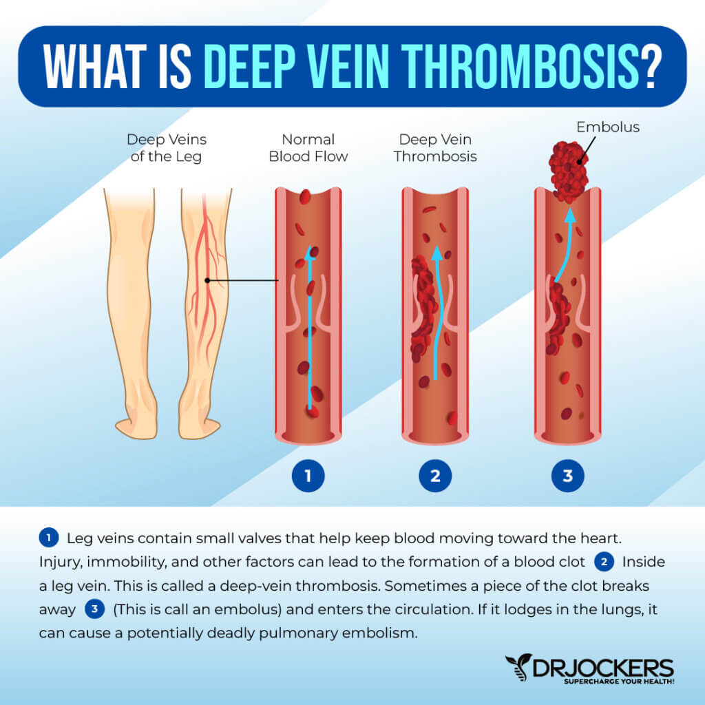 Deep Vein Thrombosis: Causes, Symptoms and Support Strategies
