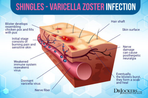 Shingles: Symptoms, Risk Factors, and Natural Support Strategies