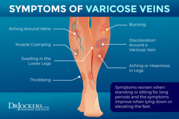 Varicose Veins: Symptoms, Causes and Natural Support Strategies