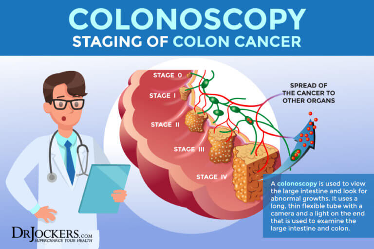 Colon Cancer: Symptoms, Causes and Support Strategies