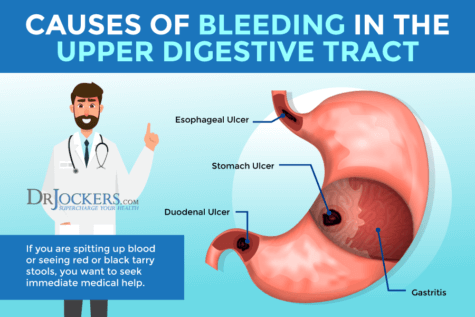 Gastritis: Symptoms, Causes, and Support Strategies - DrJockers.com