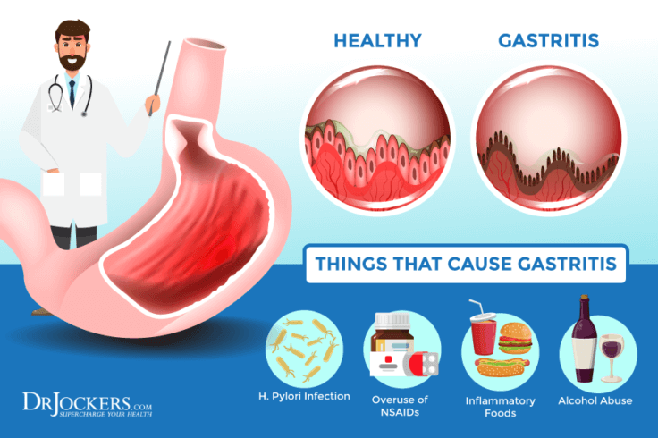 Gastritis: Symptoms, Causes, and Support Strategies - DrJockers.com