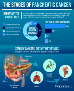 Pancreatic Cancer: Symptoms, Causes and Support Strategies