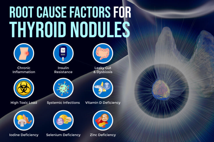 Thyroid Nodules: Symptoms, Causes, and Support Strategies Thyroid Nodules: Symptoms, Causes, and Support Strategies