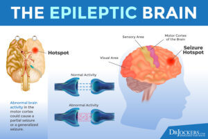 Epilepsy: Risk Factors and Natural Support Strategies - DrJockers.com