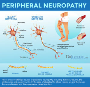 Neuropathy: Risk Factors, Causes and Support Strategies